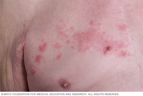 Waspadai! Berikut Gejala dan Penyebab Cacar Api | Narasi TV